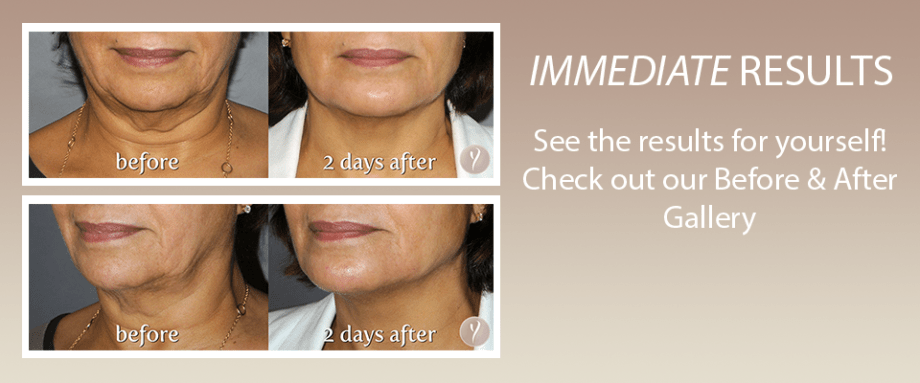 Y LIFT® & chYnjection™ Before & After Gallery | Saggy Jowls